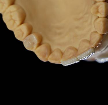 China IPS Emax Press Lithium Disilicate Dental Inlay 470 MPa High Strength China Dental Lab for sale