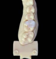 China IPS Emax Press Lithium Disilicate Dental Inlay 470 MPa High Strength China Dental Lab for sale