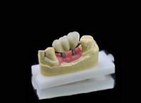 China Medical Grade Titanium Zirconia Dental Implant Abutment CNC Precision Universal Compatibility for sale