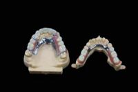 China Cobalt Chromium Alloy Dental Framework For Biocompatible Removable Partial Dentures for sale