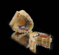 China Cobalt Chromium Alloy Dental Framework With Precision Digital Workflow for sale