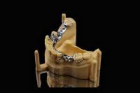 China 3D Printed Cobalt Chromium Partial Framework for Removable Partial Dentures 25-50 Micron Layer for sale