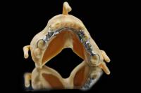 China 3D Printed Cobalt Chromium Partial Framework for Removable Partial Dentures 25-50 Micron Layer for sale