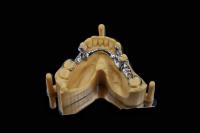 China 3D Printed Cobalt Chromium Alloy Framework for Removable Partial Dentures 800 MPa for sale