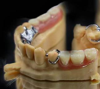 China Cobalt Chromium Alloy CCP Framework Dental Lab Polished Surface for sale