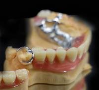 China Biocompatible 3D Printed Cast Metal Framework With Resin Denture Bases for sale