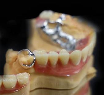 China Biocompatible 3D Printed Cast Metal Framework With Resin Denture Bases for sale