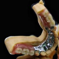China Biocompatible 3D Printed Cast Metal Framework With Resin Denture Bases for sale