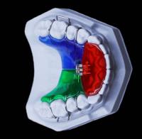 China Rapid Expansion Maxillary Expander Hyrax Tooth Borne Design for sale