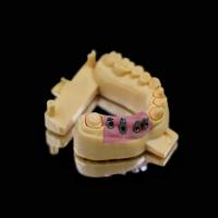 China China Outsourcing Dental Lab Porcelain-Fused-to-Metal (PFM) Crowns for sale