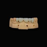 China Best Teeth Craftsman Porcelain-Fused-to-Metal (PFM) Crowns for sale