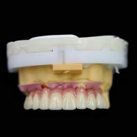 China Sterilized Dental Implant System Featuring Biocompatible Materials for Enhanced Osseointegration and Patient Comfort for sale