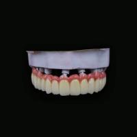 China Precision Engineered Artificial Tooth Implant Offering Optimal Fit and Functionality for Effective Dental Rehabilitation for sale