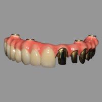 China Dental Implant Lab | Class 2 Hybrid Malong Full Arch AOX Implant Bridge Titanium Bar With Full Solid Zirconia for sale