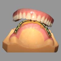 China Lmplant Dental Laboratory | Full Acrylic Denture All On X Dental Lmplants AOX Class 4 With Locator Attachment for sale