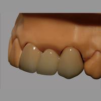 China ADL Dental Laboratories Inc | Biocompatible Full Ceramic PFZ Bridge With CAD / CAM System for sale