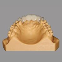 China China Outsourcing Dental Lab | Aesthetic Porcelain Fused To Zirconia Bridge Hypoallergenic for sale