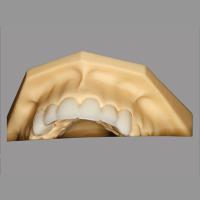 China China Outsourcing Dental Lab | Aesthetic Porcelain Fused To Zirconia Bridge Hypoallergenic for sale