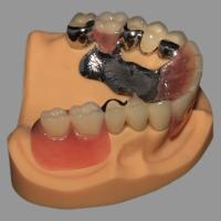 China China Dental Lab Outsourcing | Dental Crown Lab | CoCr Acrylic Cast Metal Partial Combined With Fixed PFM for sale