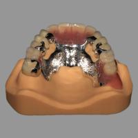 China CoCr Acrylic Cast Metal Partial Combined With Fixed PFM for sale