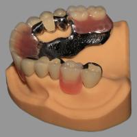 China China Dental Lab Outsourcing | Dental Crown Lab | CoCr Acrylic Cast Metal Partial Combined With Fixed PFM for sale