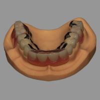 China China Dental Lab Outsourcing | Dental Crown Lab | CoCr Acrylic Cast Metal Partial Combined With Fixed PFM for sale