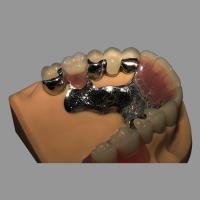 China China Dental Lab Outsourcing | Dental Crown Lab | CoCr Acrylic Cast Metal Partial Combined With Fixed PFM for sale