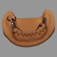 China Dental Lab Outsourcing Services | Vitallium 2000 Cast Metal Framework Dental Bar Design Corrosion Resistant for sale