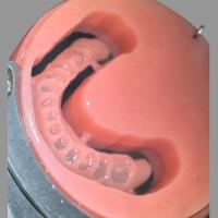 China China Dental Laboratory | CAD/CAM Digital Milled Acrylic Base Denture Removable for sale