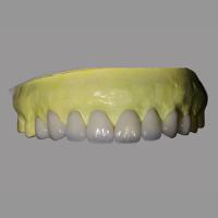 China High Translucency IPS E Max Veneers Stains Resistant Biocompatible for sale