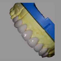China High Translucency IPS E Max Veneers Stains Resistant Biocompatible for sale