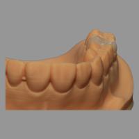 China Emax  Dental Lab | Full Ceramic Dental Emax Inlay Onlay Crown Pressed / Milled for sale