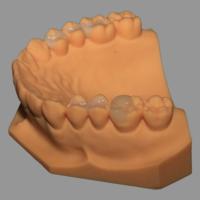 China Emax  Dental Lab | Full Ceramic Dental Emax Inlay Onlay Crown Pressed / Milled for sale