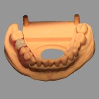 China Flexible Denture Price | ChinaCasting Valplast Dental Partials Unilateral Design Hypoallergenic for sale