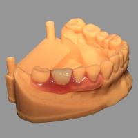 China Casting Valplast Dental Partials Unilateral Design Hypoallergenic for sale