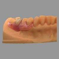 China Flexible Denture Price | ChinaCasting Valplast Dental Partials Unilateral Design Hypoallergenic for sale