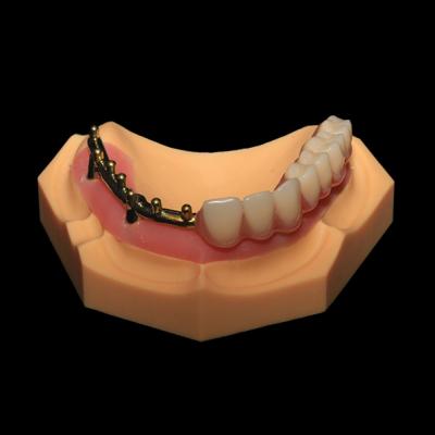 China Class 3 Milled Titanium Bar All On X Dental Implants with Full Acrylic Denture for sale