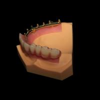 China Dental Implant Laboratory | Class 3 Milled Titanium Bar All On X Dental Lmplants With Full Acrylic Denture for sale