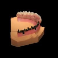 China Dental Implant Laboratory | Class 3 Milled Titanium Bar All On X Dental Lmplants With Full Acrylic Denture for sale