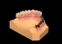 China Dental Implant Laboratory | Class 3 Milled Titanium Bar All On X Dental Lmplants With Full Acrylic Denture for sale