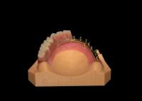 China Dental Implant Laboratory | Class 3 Milled Titanium Bar All On X Dental Lmplants With Full Acrylic Denture for sale