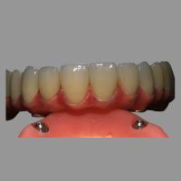 China Dental Implant Lab | Class 2 Hybrid Malong Full Arch AOX Implant Bridge Titanium Bar With Full Solid Zirconia for sale