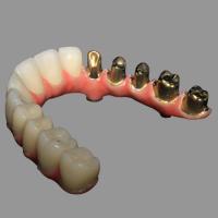 China Class 2 Hybrid Malong Full Arch AOX Implant Bridge Titanium Bar with Full Solid Zirconia for sale