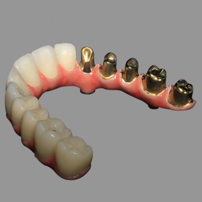 China Class 2 Hybrid Malong Full Arch AOX Implant Bridge Titanium Bar with Full Solid Zirconia for sale