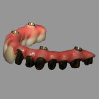 China Dental Implant Lab | Class 2 Hybrid Malong Full Arch AOX Implant Bridge Titanium Bar With Full Solid Zirconia for sale