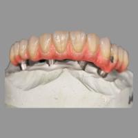 China ADL Dental Iaboratories limited | Class I AOX Implants All On 4 Hybrid Titanium Screw Retained Full Zirconia for sale