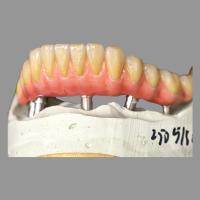 China ADL Dental Iaboratories limited | Class I AOX Implants All On 4 Hybrid Titanium Screw Retained Full Zirconia for sale