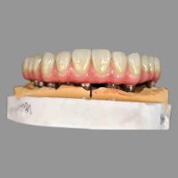 China ADL Dental Iaboratories limited | Class I AOX Implants All On 4 Hybrid Titanium Screw Retained Full Zirconia for sale