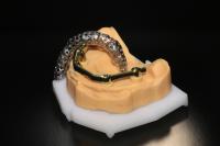 China Gigital Dental Laboratory | Class 5 All On 4 AOX Implants With Hybrid Titanium Bar / Clips / Metal Mesh / Full Denture for sale