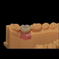China Implant Dental Lab | Silver Custom Titanium Abutments Dental Implants With Full Zirconia Crown for sale